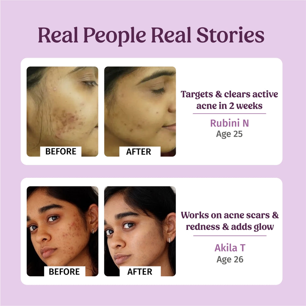 Buy Honeyfix Facewash Online for Oily & Acne Prone Skin - Vilvah